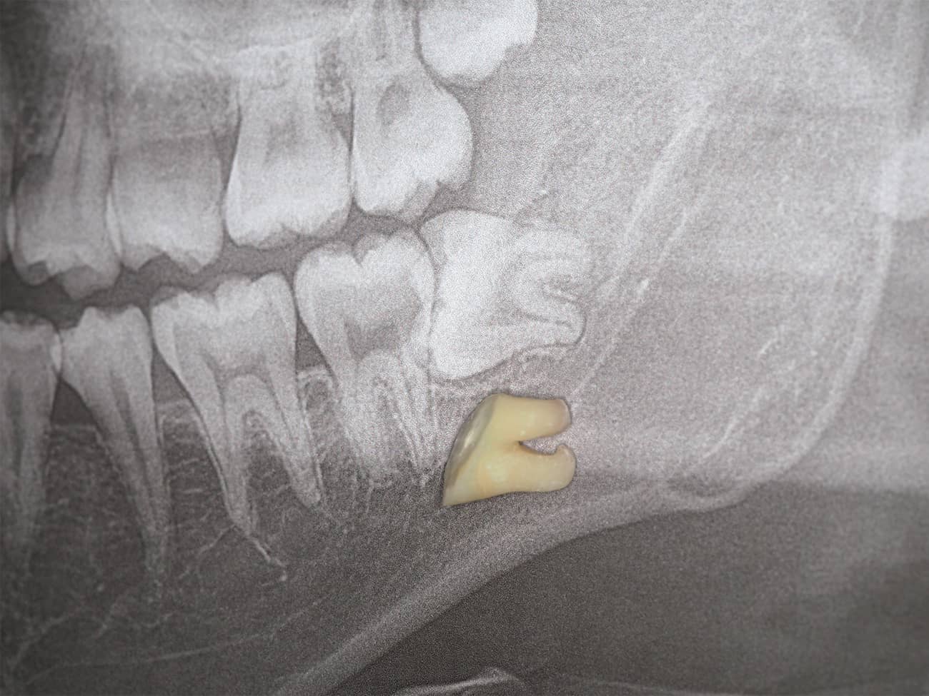 Abnormal Angulation Treatment - Wisdom Tooth Surgery - Tooth & Co.