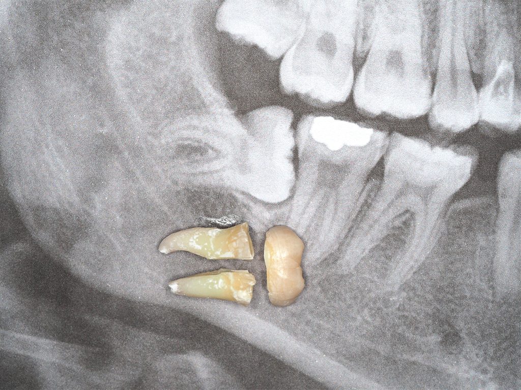 Abnormal Angulation Treatment - Wisdom Tooth Surgery - Tooth & Co.